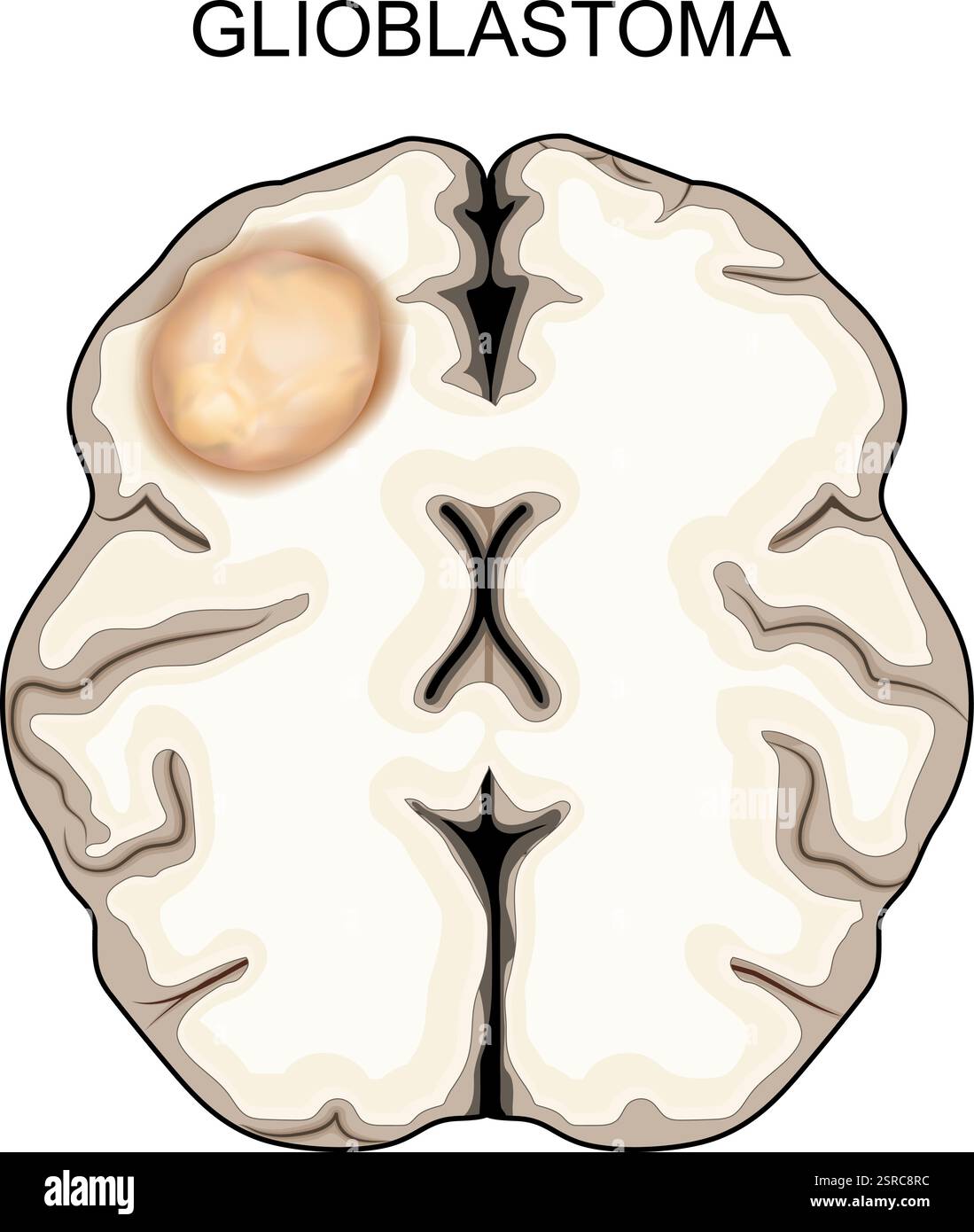 Glioblastoma. Brain tumor. Malignant cancer. Vector illustration Stock ...