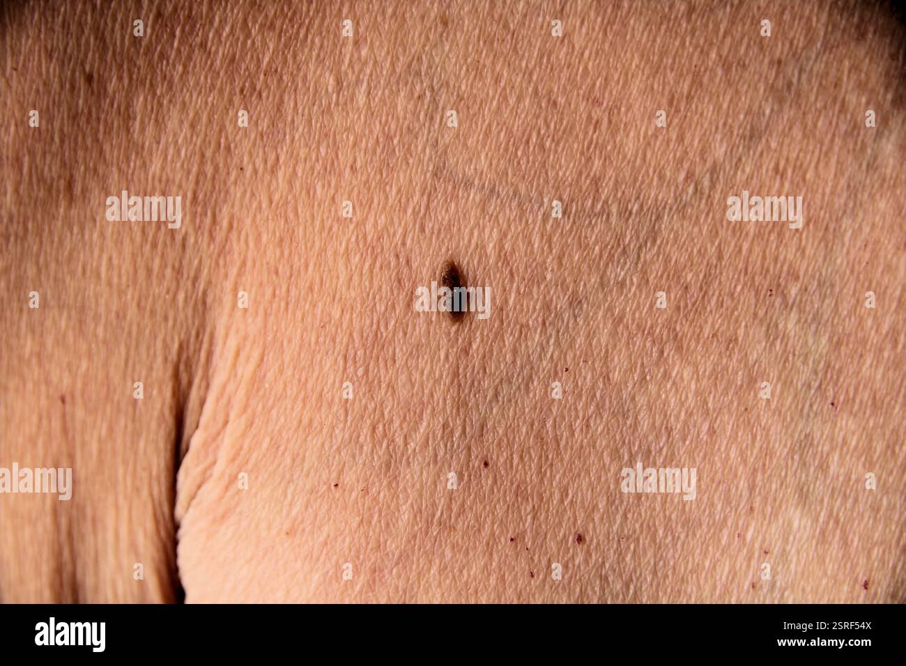 Dark skin tag (Acrochordon) on chest of 65 year-old female Stock Photo ...