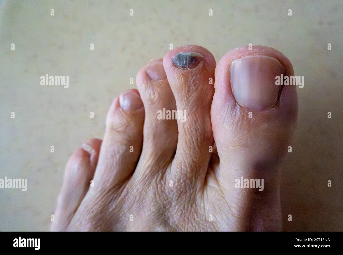 Black toenail on foot Stock Photo - Alamy
