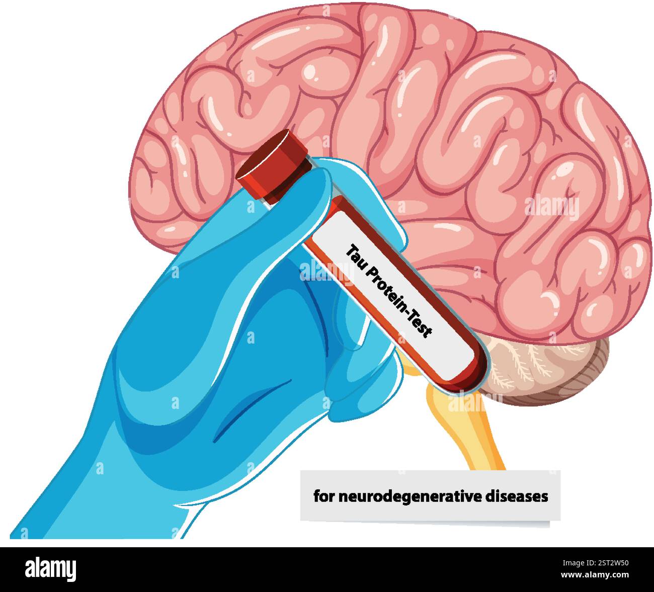 Illustration of tau protein test for neurodegenerative diseases Stock ...
