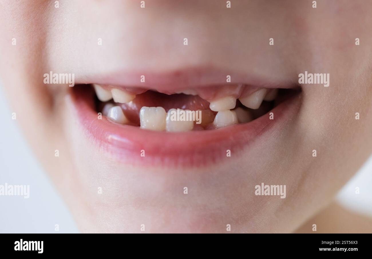 Close-up of a child mouth with crooked teeth, highlighting dental ...