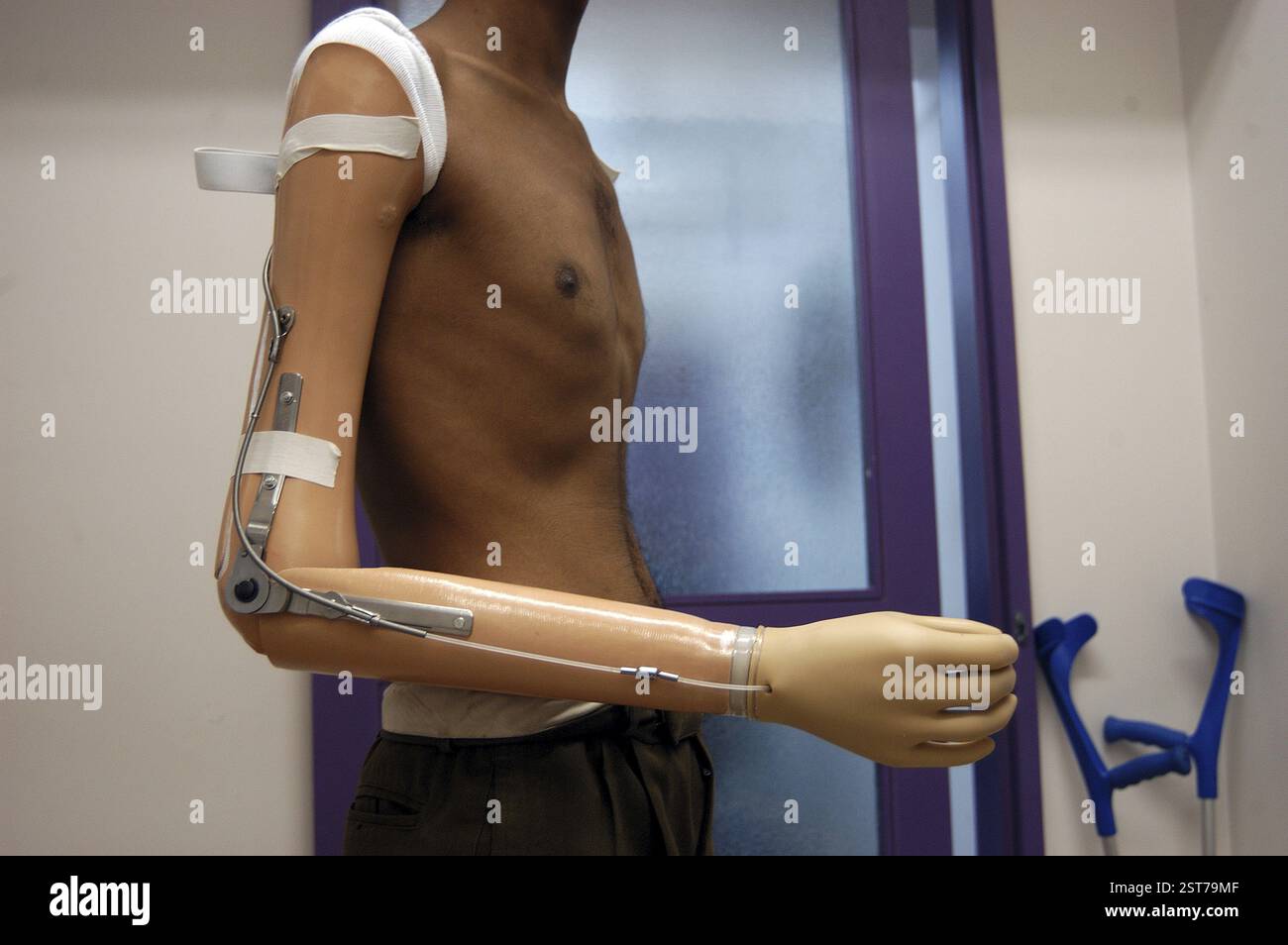A prosthetic hand fitted on a handicapped person Stock Photo - Alamy