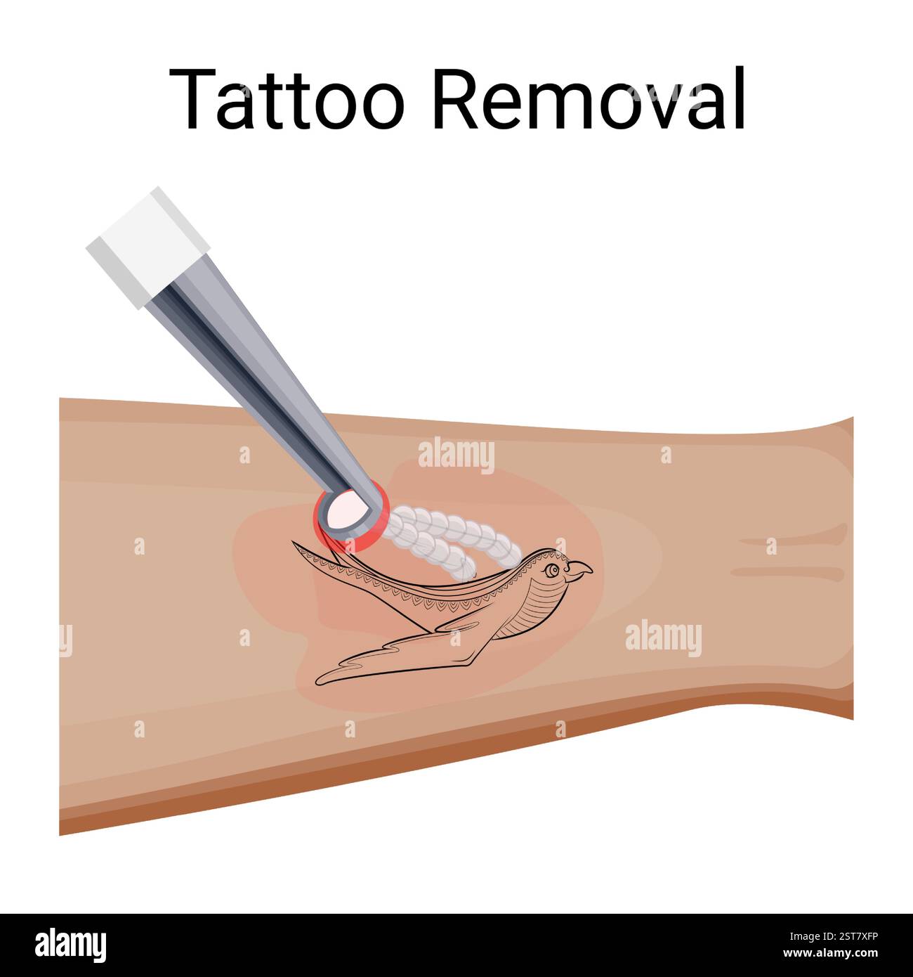 Tattoo laser removal Cut Out Stock Images & Pictures - Alamy