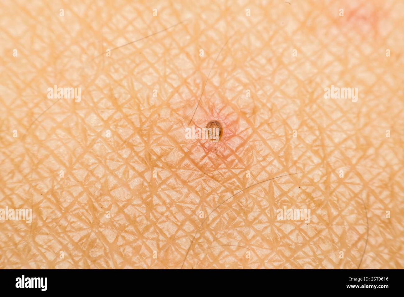 Macro of dry skin asia human with dermatology Stock Photo - Alamy