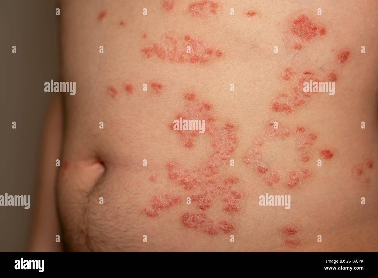 Red scaly patches on skin indicating psoriasis condition affecting the ...
