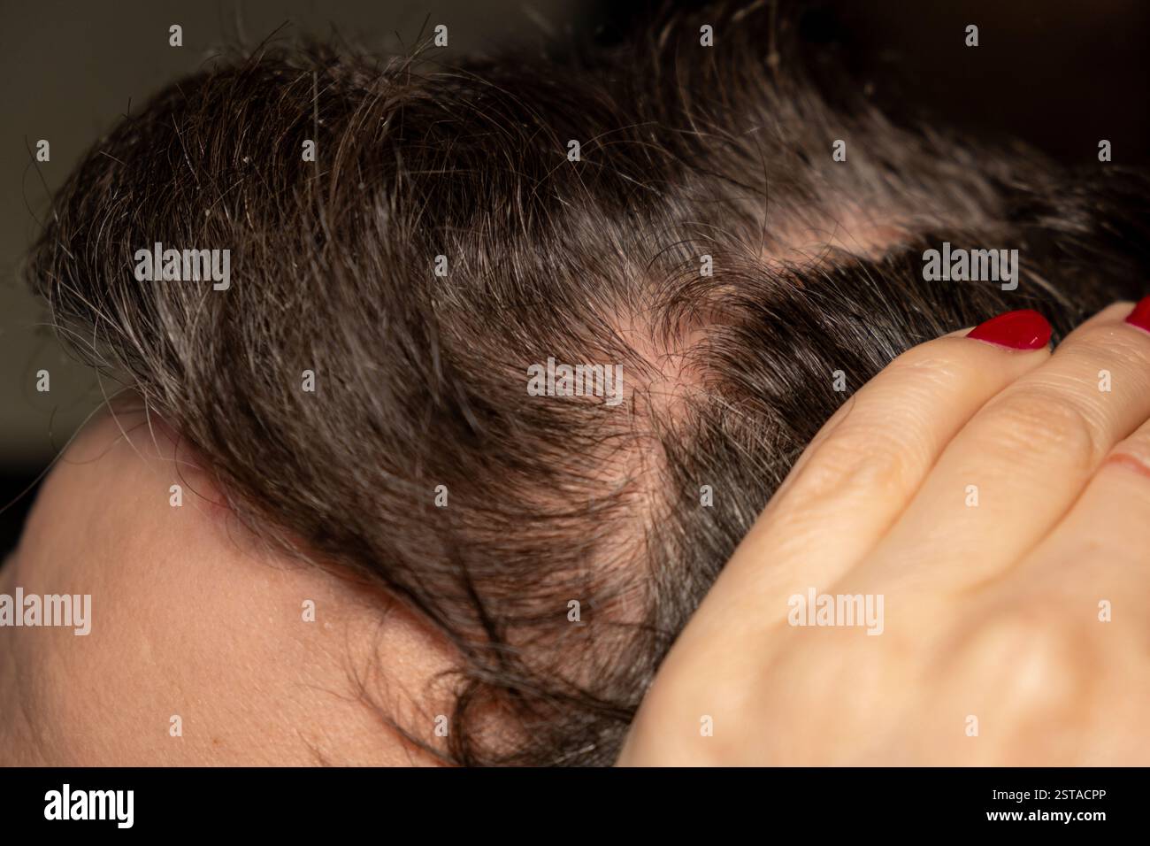 Scalp psoriasis characterized by red patches and scaly skin ...