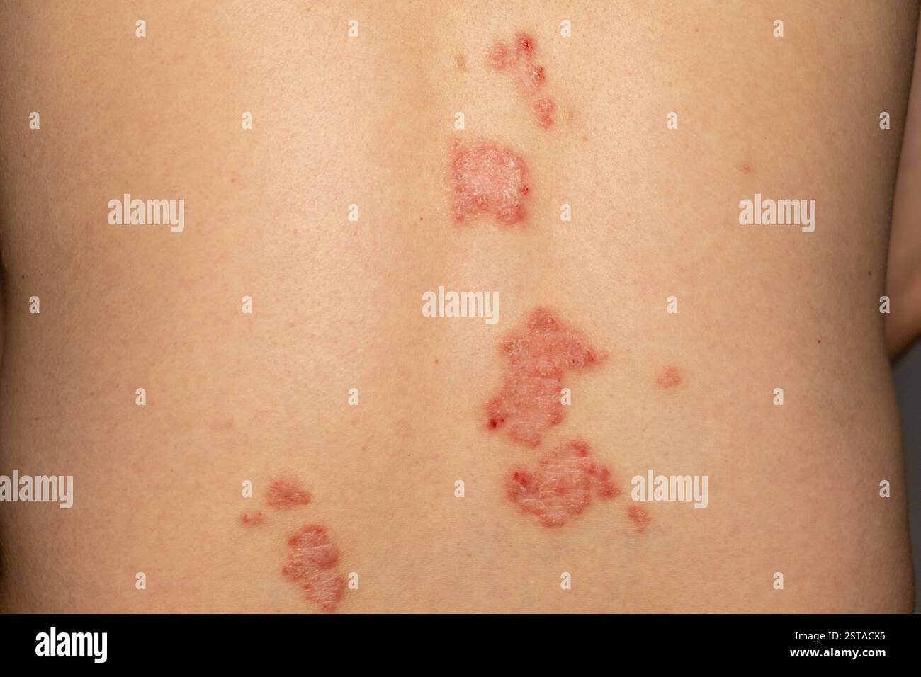 Psoriasis patches on skin highlighting symptoms of a chronic immune ...