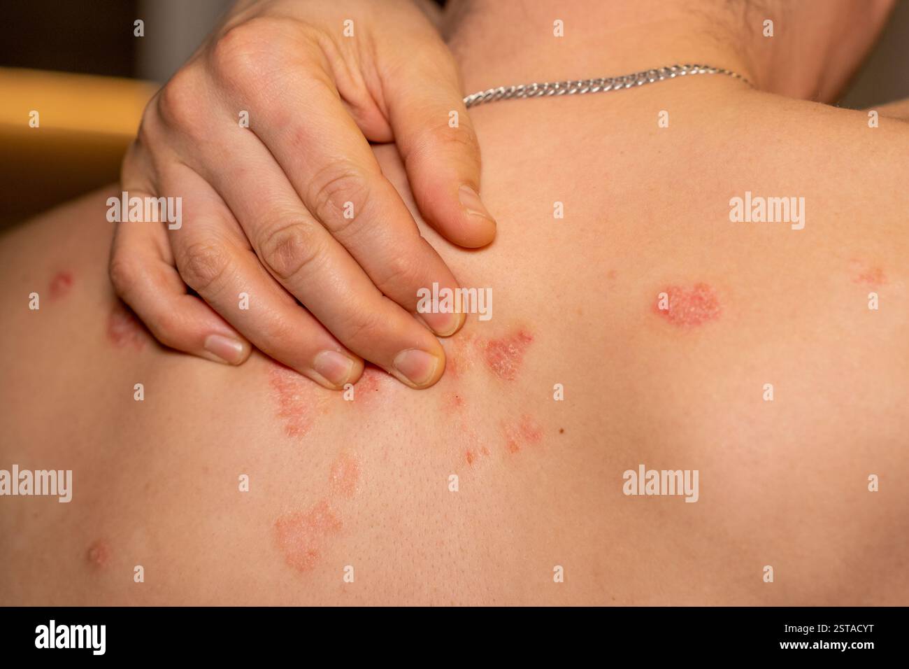 Psoriasis manifests as itchy, scaly patches on the skin, affecting individuals with this genetic ...