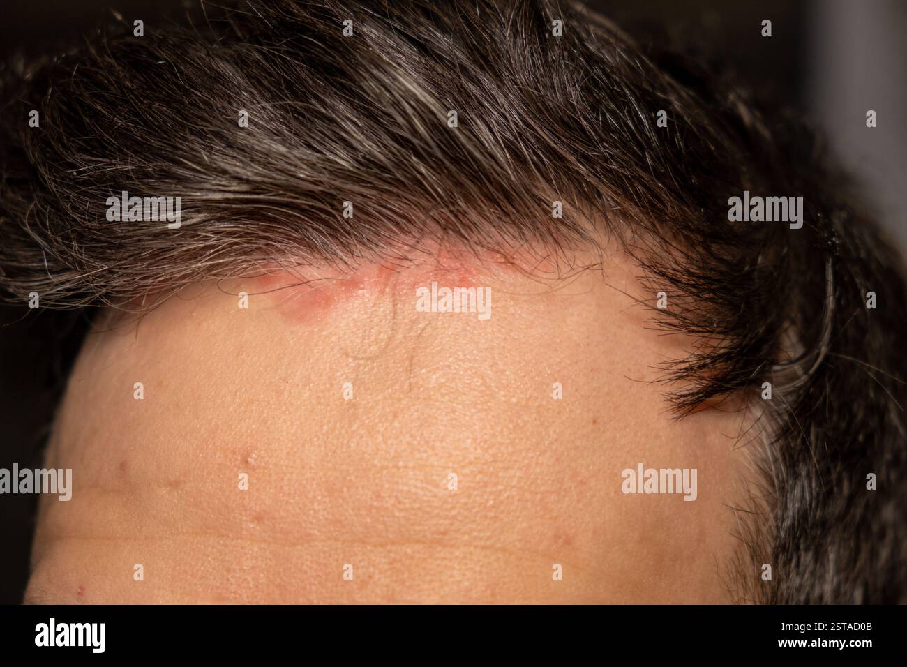 Skin patches appear on the scalp of a person suffering from psoriasis ...