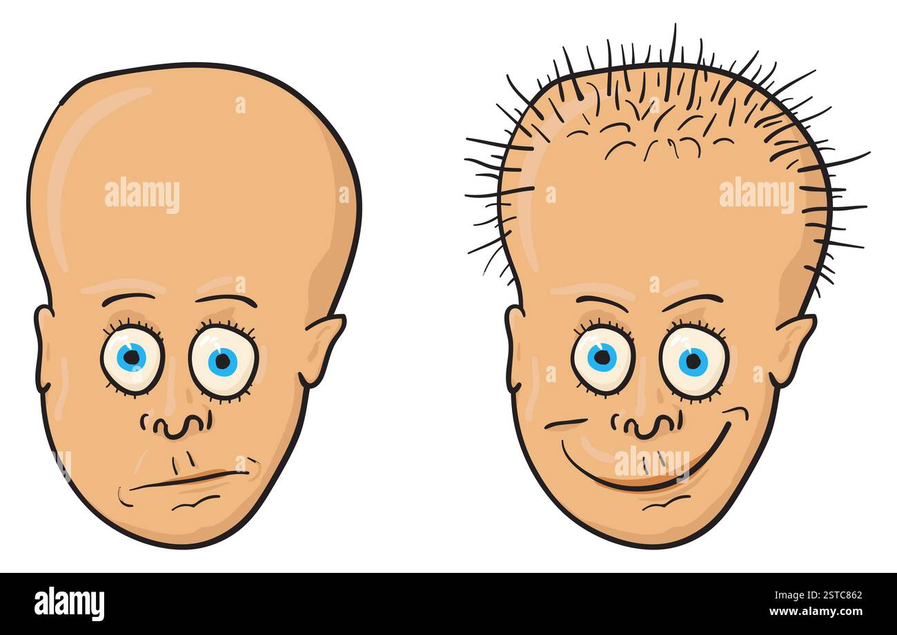 Comic illustration - A patient with a bald head and growing hair Stock ...