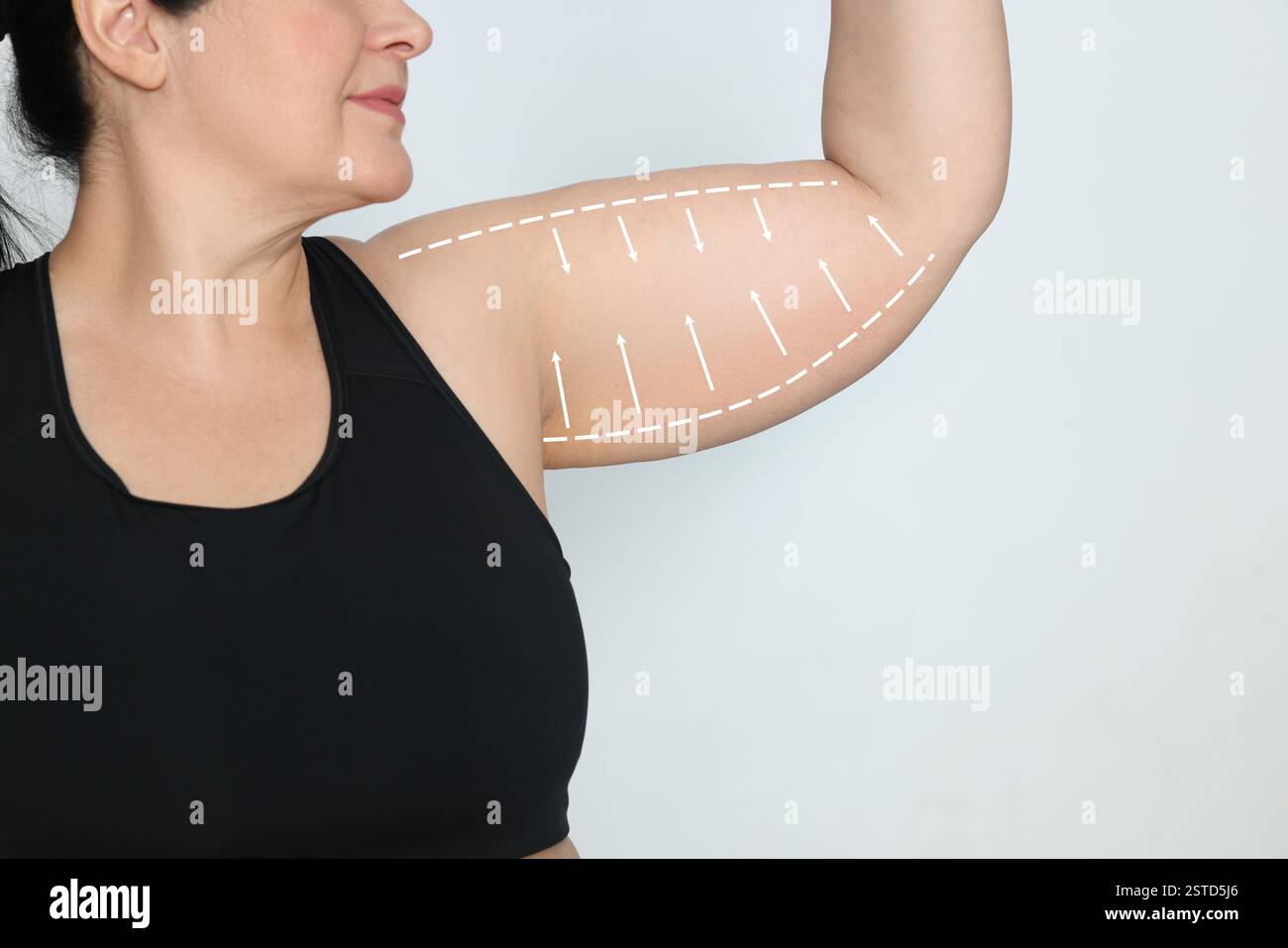 Plastic surgery. Woman showing arm with excessive fat on white ...