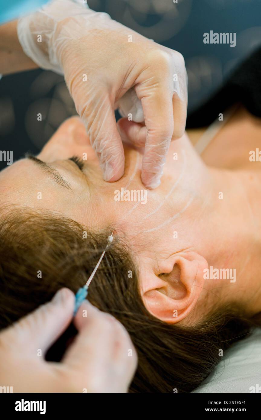 Close-up of an aesthetic clinic procedure where a practitioner, wearing gloves, applies botox ...