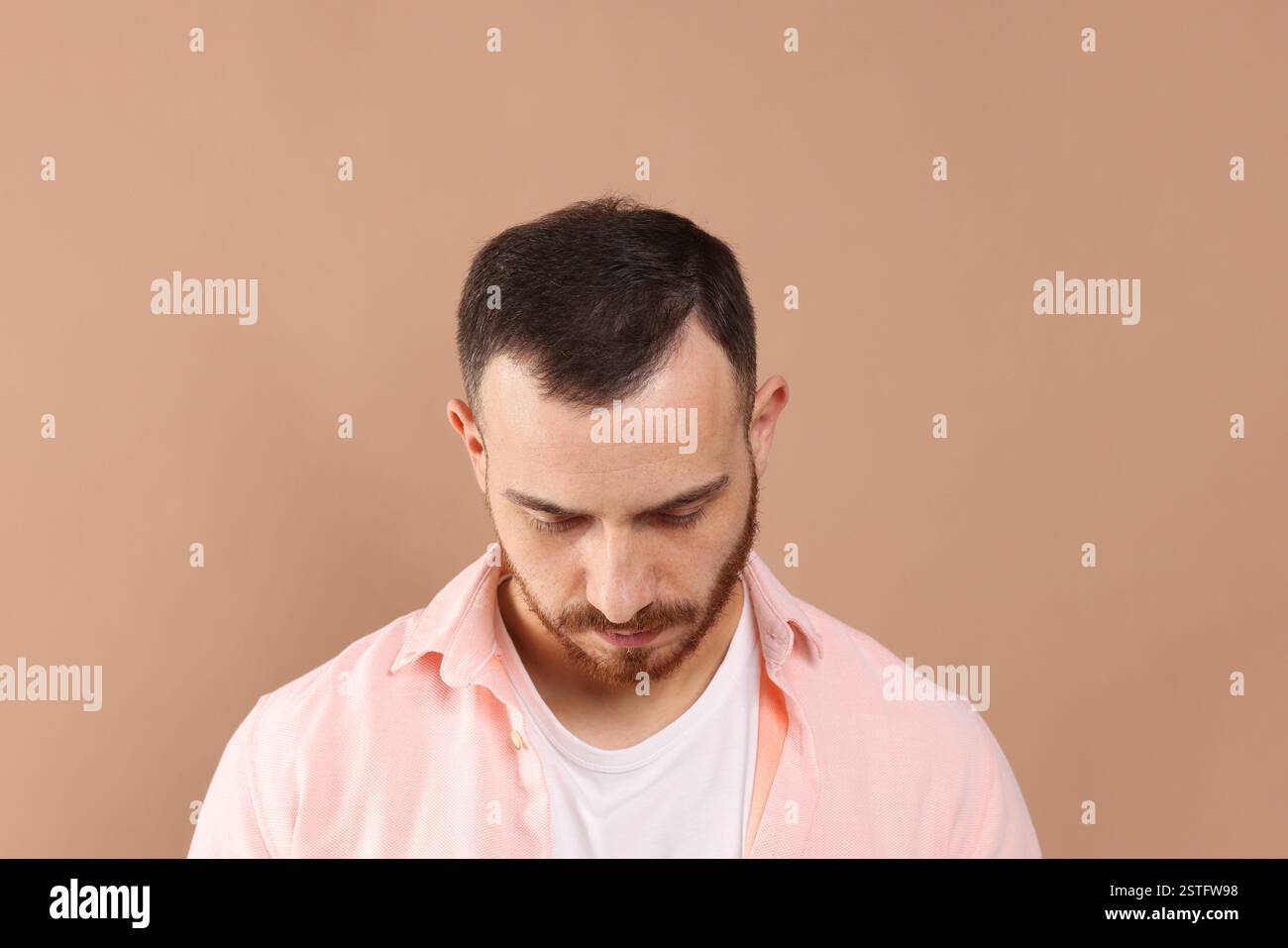 Baldness problem. Man with receding hairline on beige background Stock ...