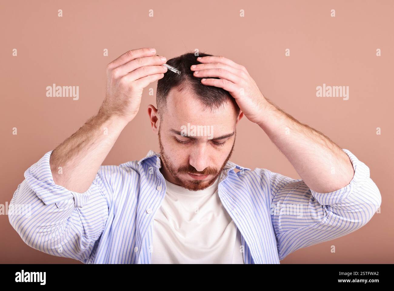 Baldness problem. Man applying serum onto hairline on dark beige ...