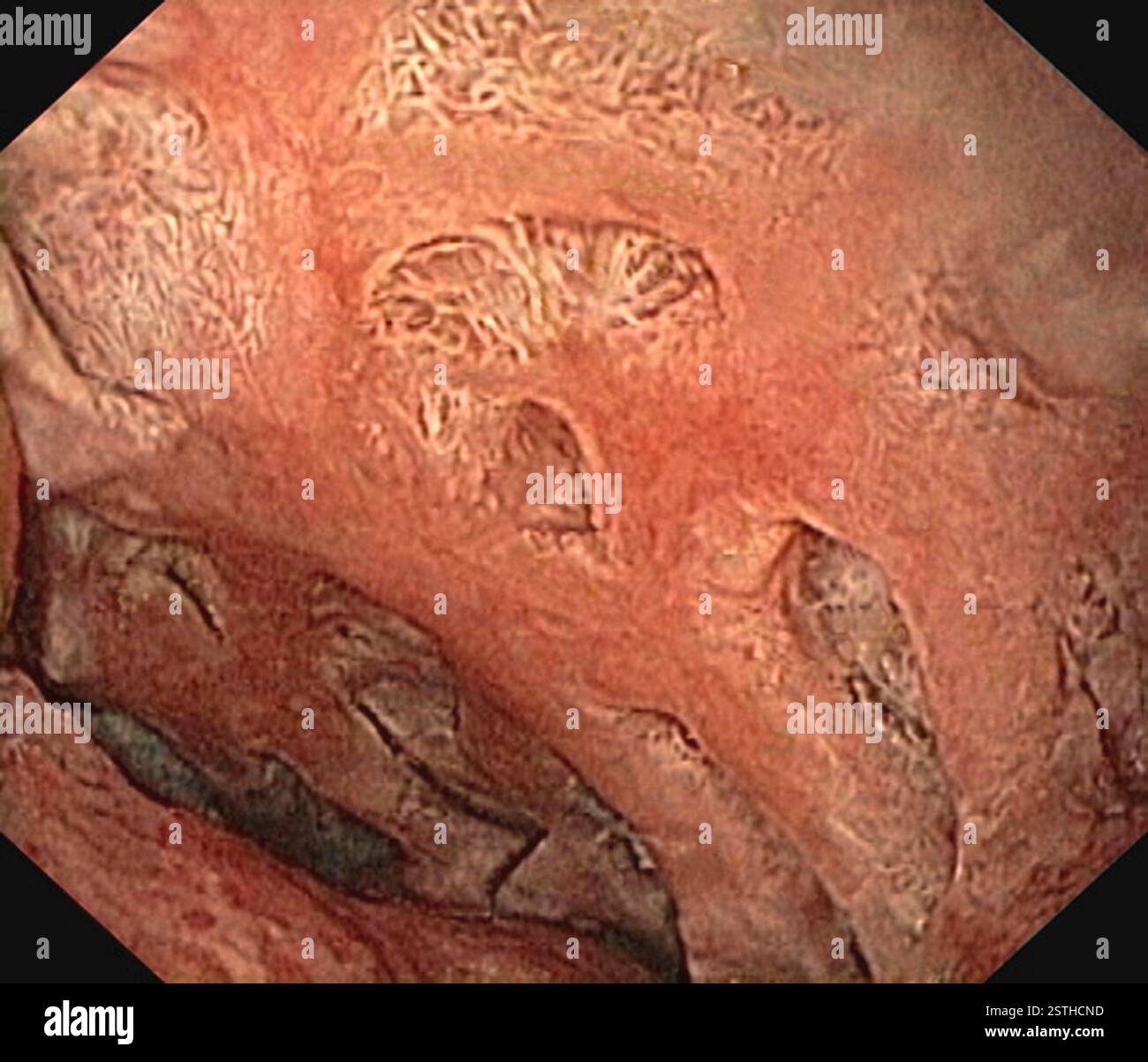 Endoscope view of the wall of the duodenum showing erosion of the ...