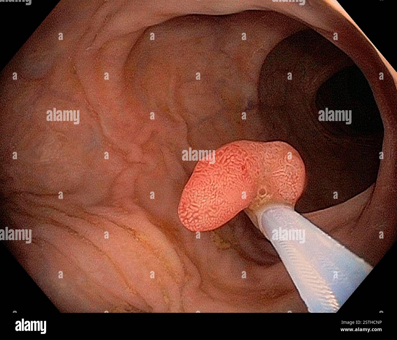 Colon polyp removal. Endoscopic view of a pedunculated (stalked) polyp ...