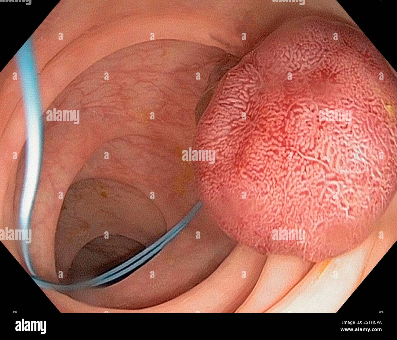 Intestinal polyp removal. Endoscope view of a polyp (centre-right ...