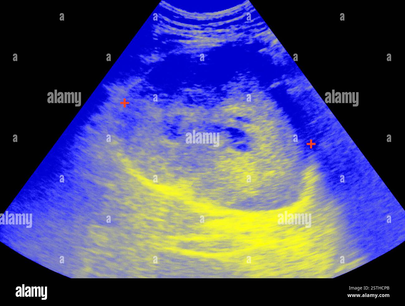 Bowel cancer. Coloured ultrasound scan showing a gastrointestinal ...