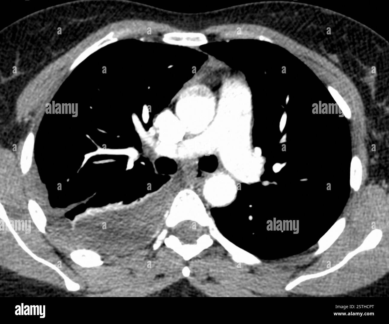 Pleural effusion. Computed tomography (CT) scan of an axial section ...