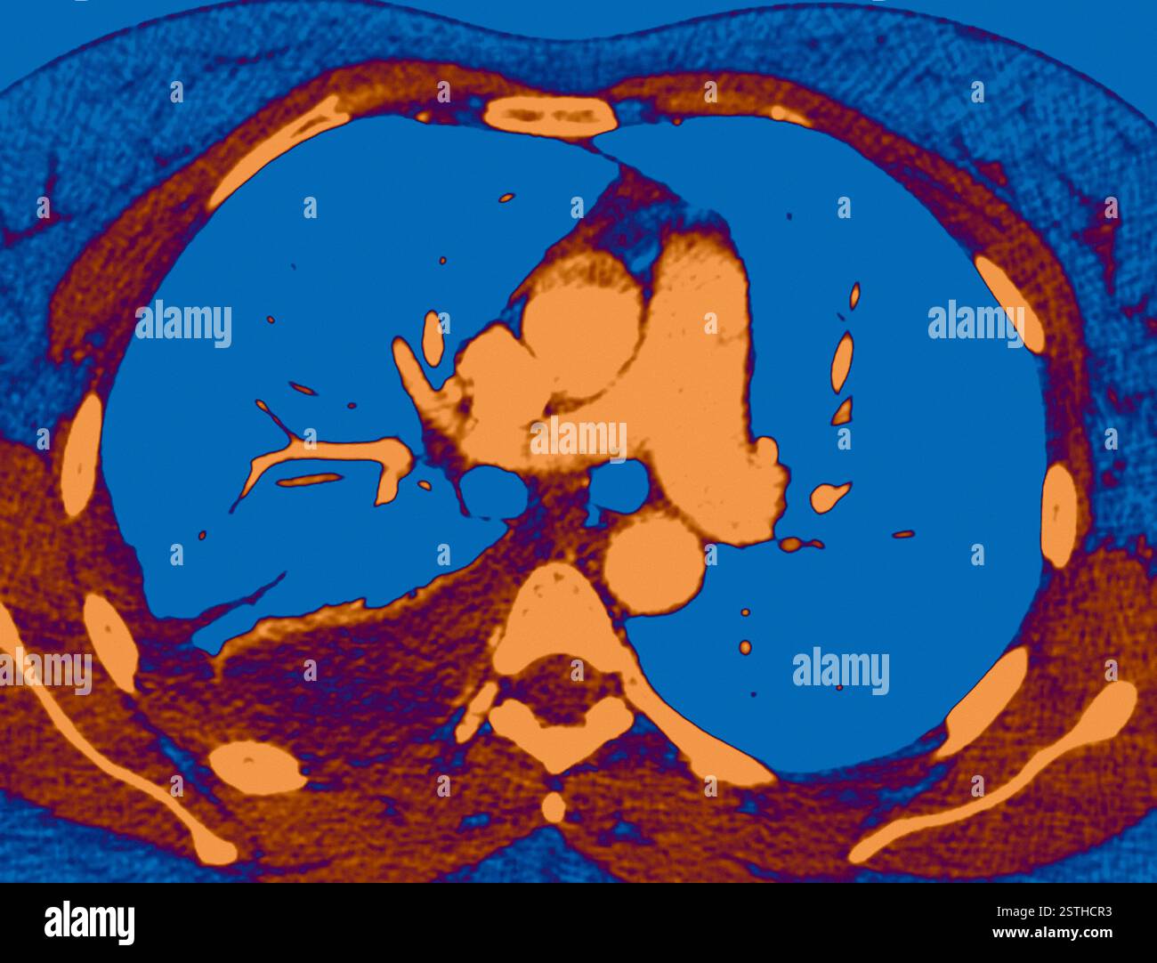 Pleural effusion. Coloured computed tomography (CT) scan of an axial section through the chest ...