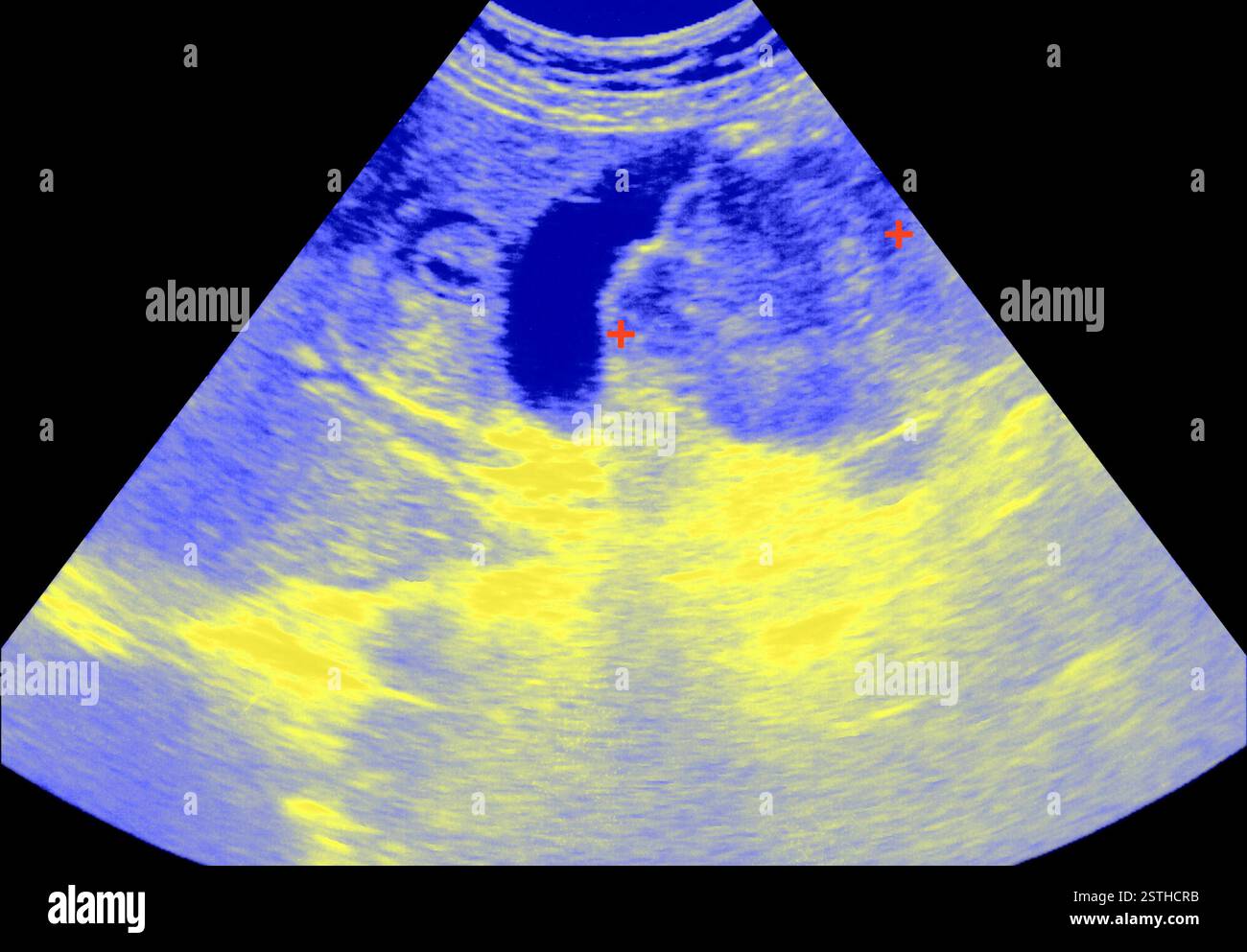 Bowel cancer. Coloured ultrasound scan showing a gastrointestinal ...