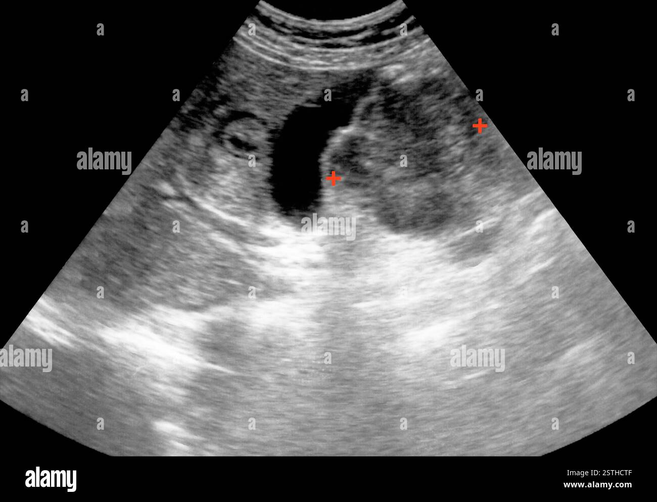 Bowel cancer. Ultrasound scan showing a gastrointestinal stromal tumour ...