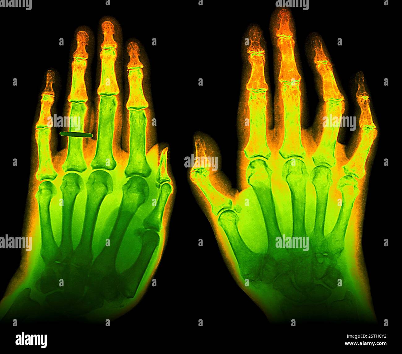 Arthritic hand. X-ray of the hands of a patient with rheumatoid ...