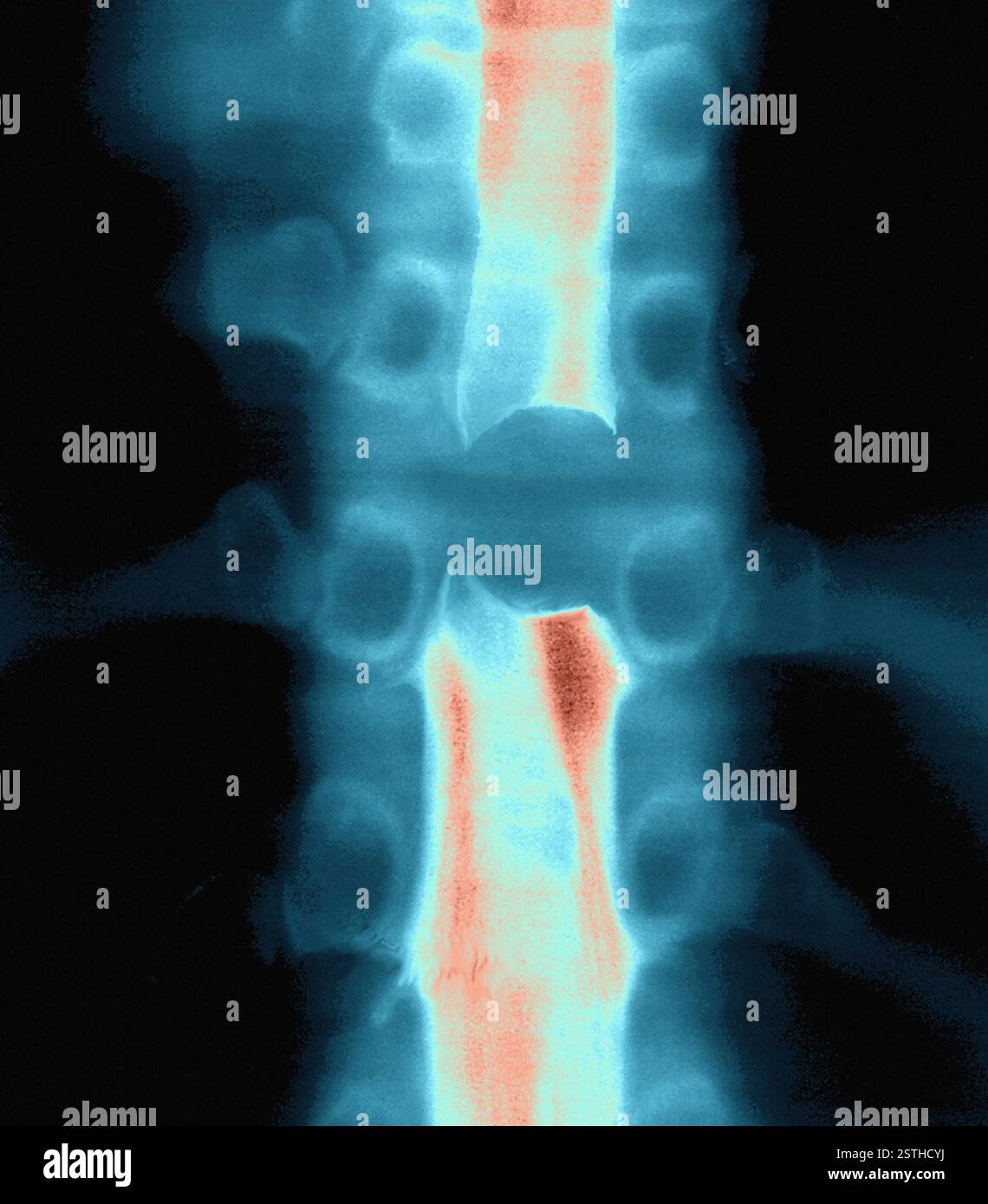 Spinal cord tumour, CT scan Stock Photo - Alamy