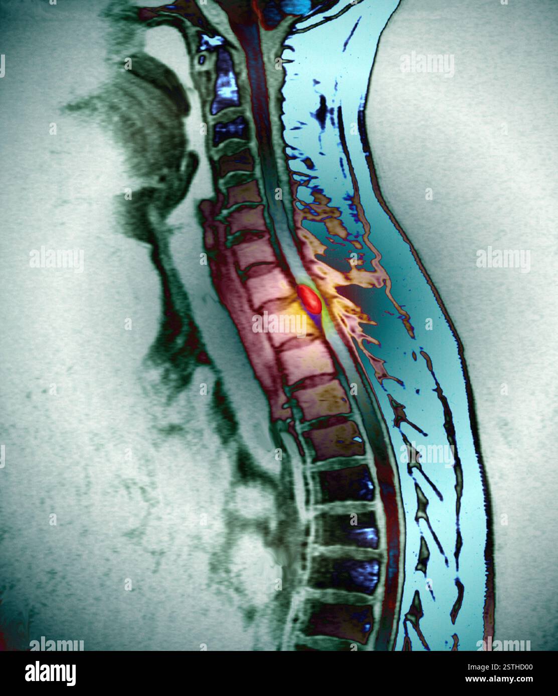 Spinal cord tumour, MRI scan Stock Photo - Alamy