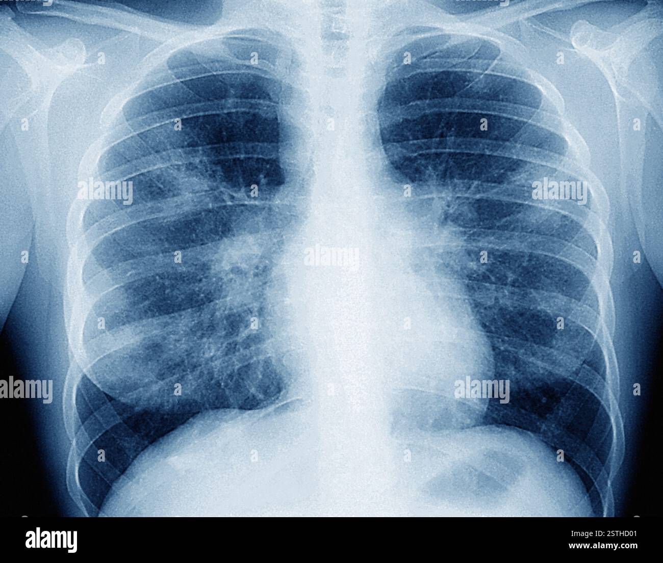 Sarcoidosis. Frontal chest X-ray of the lungs of a 25-year-old woman ...