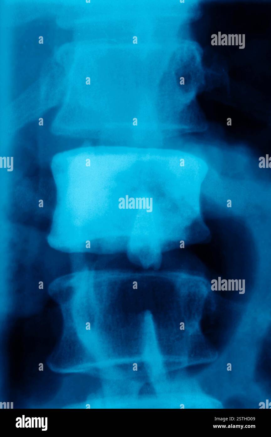 Secondary bone cancer in a 64 year old male, coloured X-ray. This ...