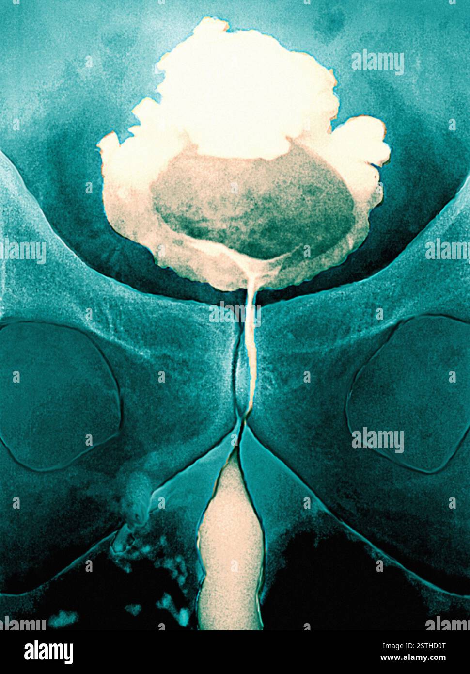 Prostate tumour, X-ray Stock Photo - Alamy