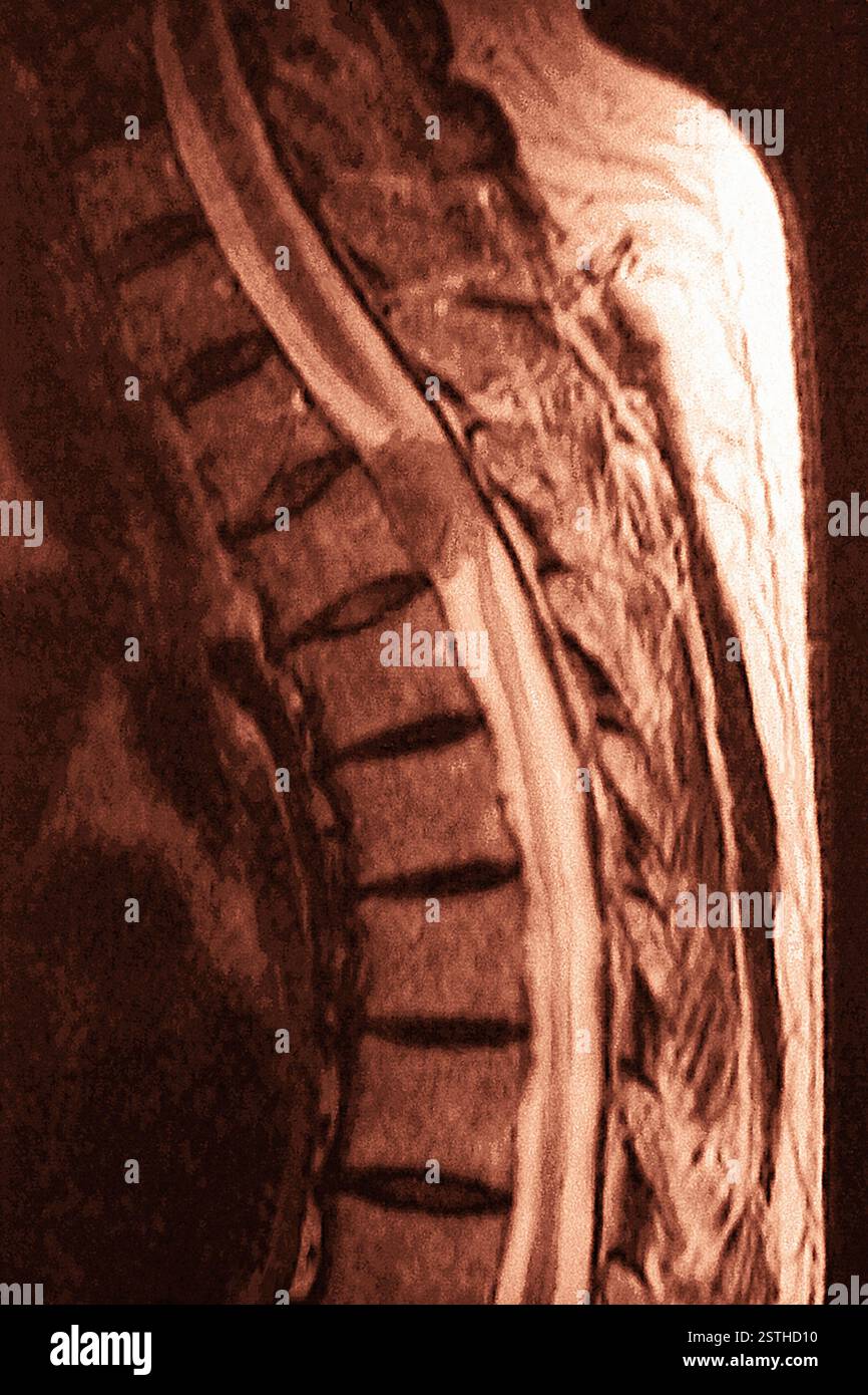 Spinal cord tumour, MRI scan Stock Photo - Alamy