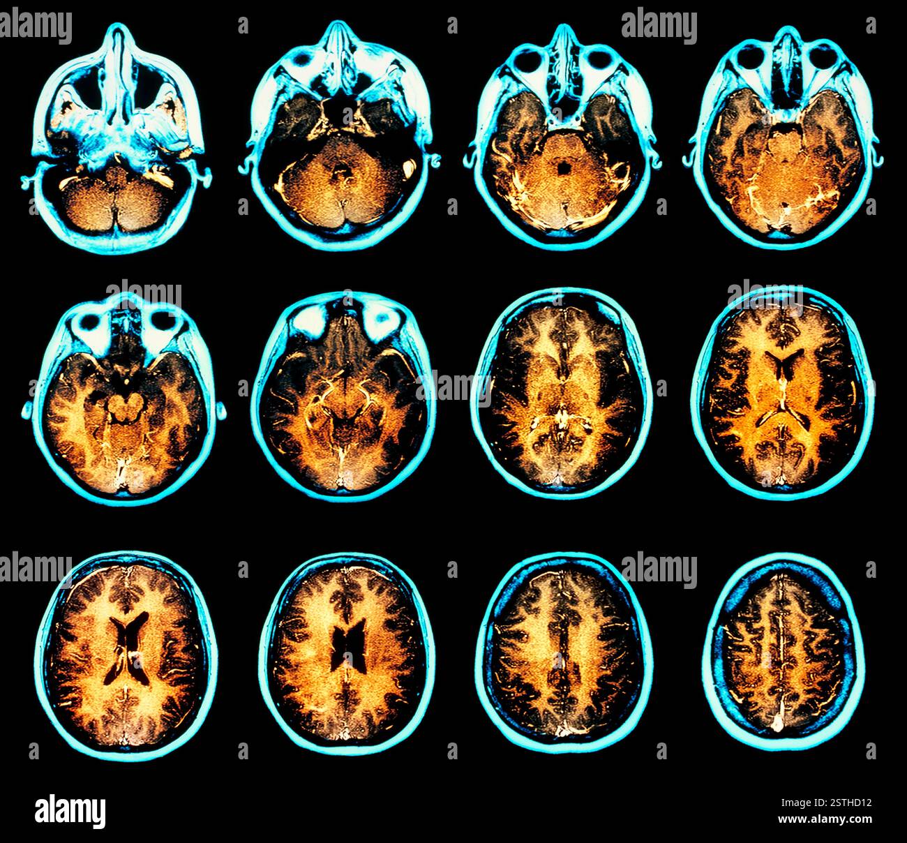 Brain anatomy, axial MRI scans Stock Photo - Alamy