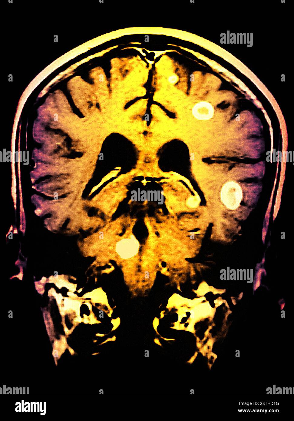 Brain tuberculosis, MRI scan Stock Photo - Alamy