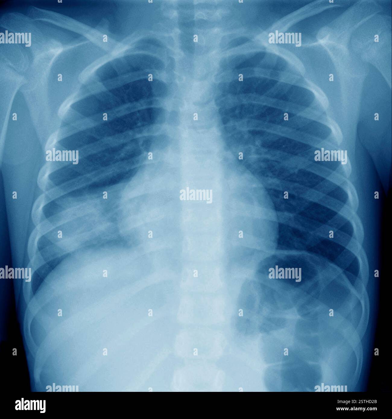 Lobar pneumonia. Frontal X-ray of the lungs of a 4-year-old boy ...