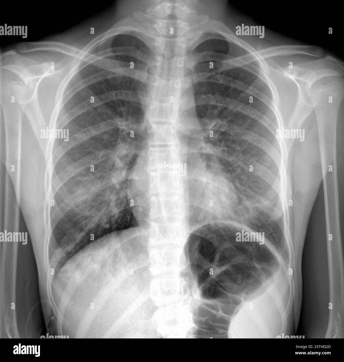 Viral pneumonia. Frontal X-ray of the lungs of a 12-year-old girl ...