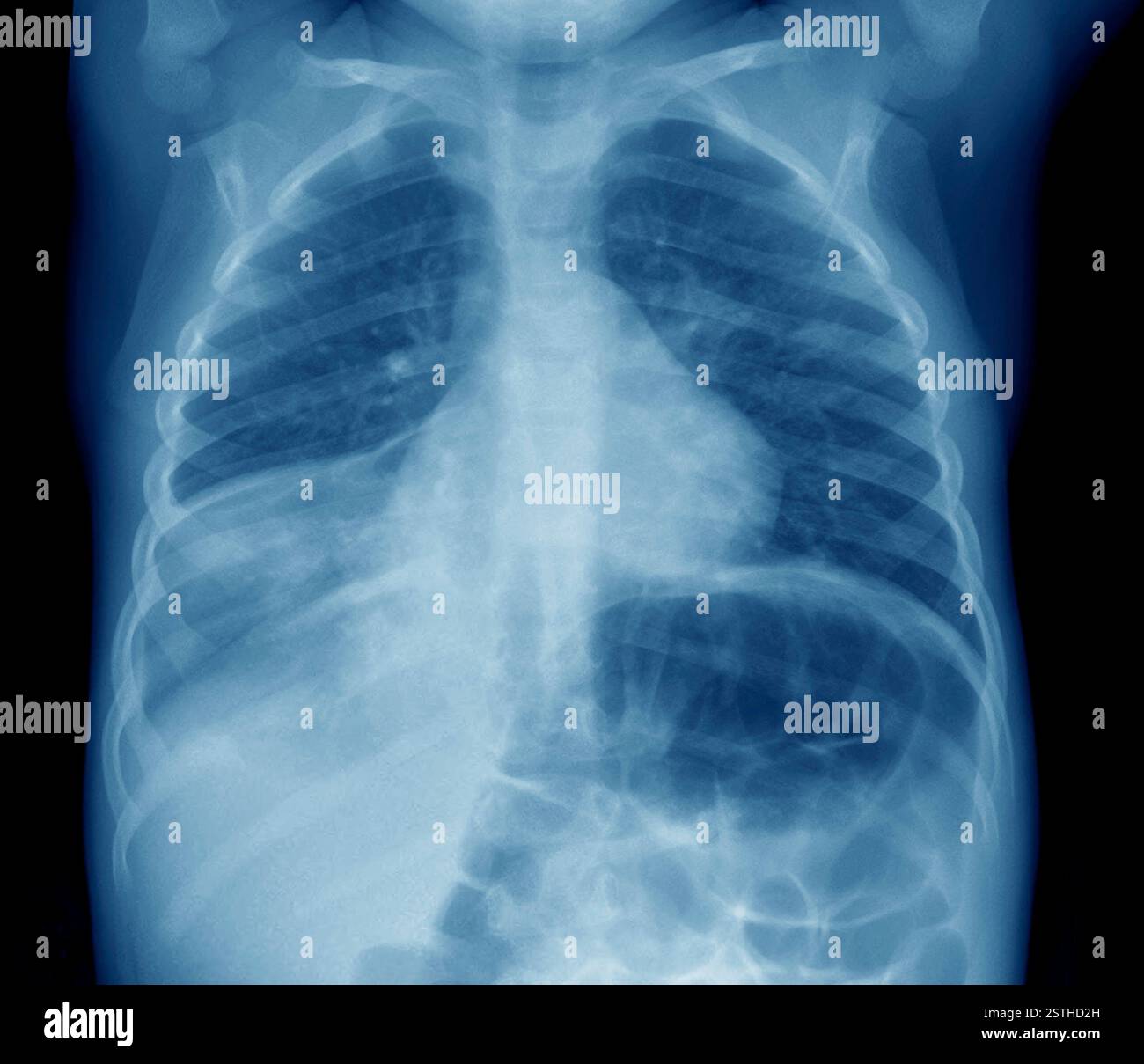 Lobar pneumonia. Frontal X-ray of the lungs of a 2-year-old girl ...
