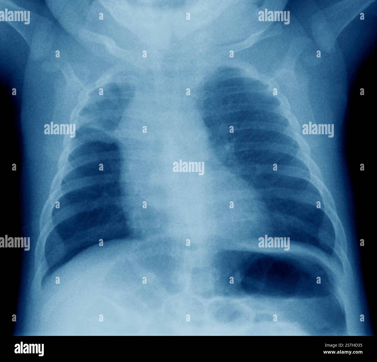 Lobar pneumonia and bronchiolitis, lung X-ray Stock Photo - Alamy