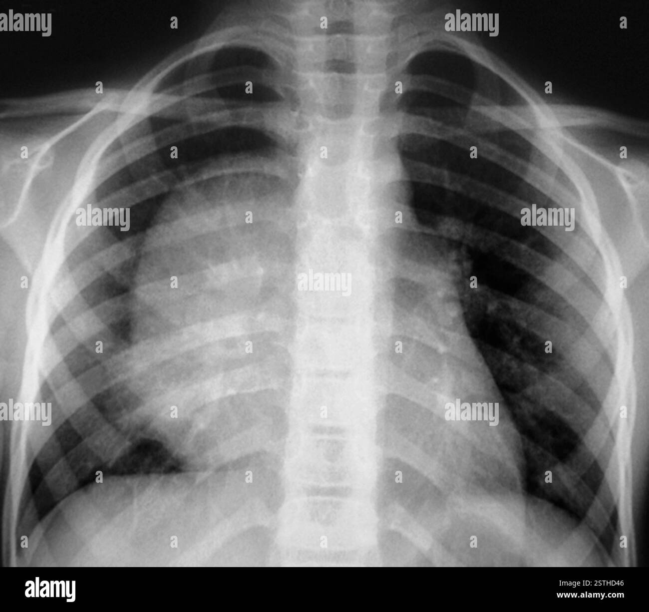 Hydatid cyst. Frontal chest X-ray of the lungs of a 5-year-old girl who ...