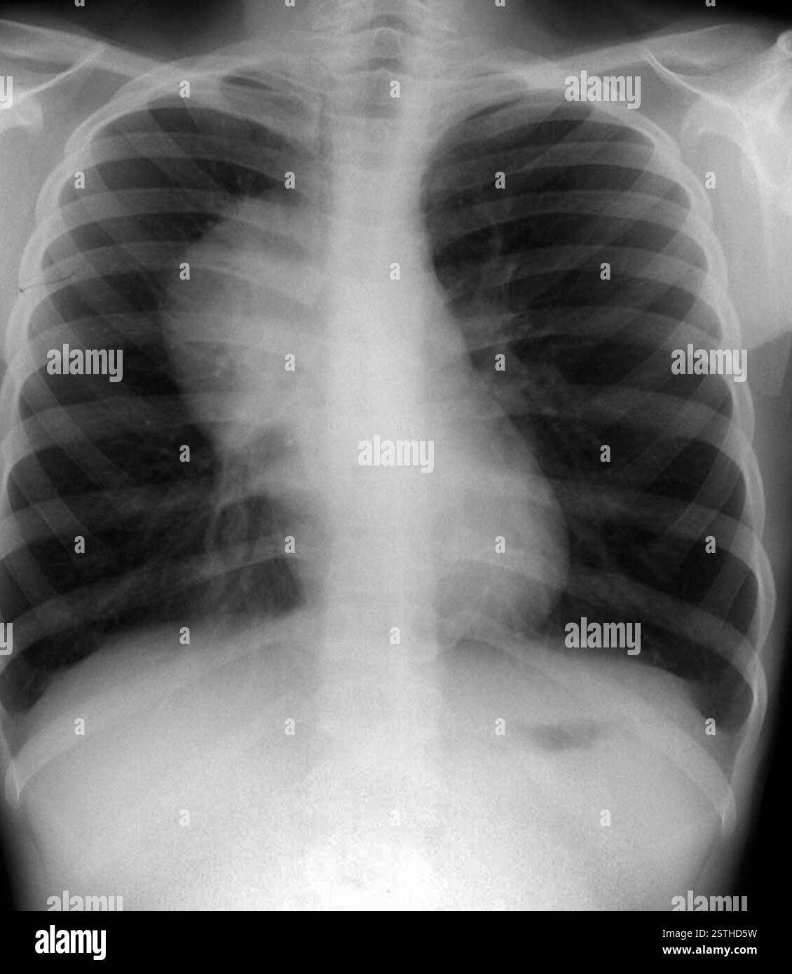 Hodgkin's disease and mediastinum. Frontal chest X-ray of the heart and ...