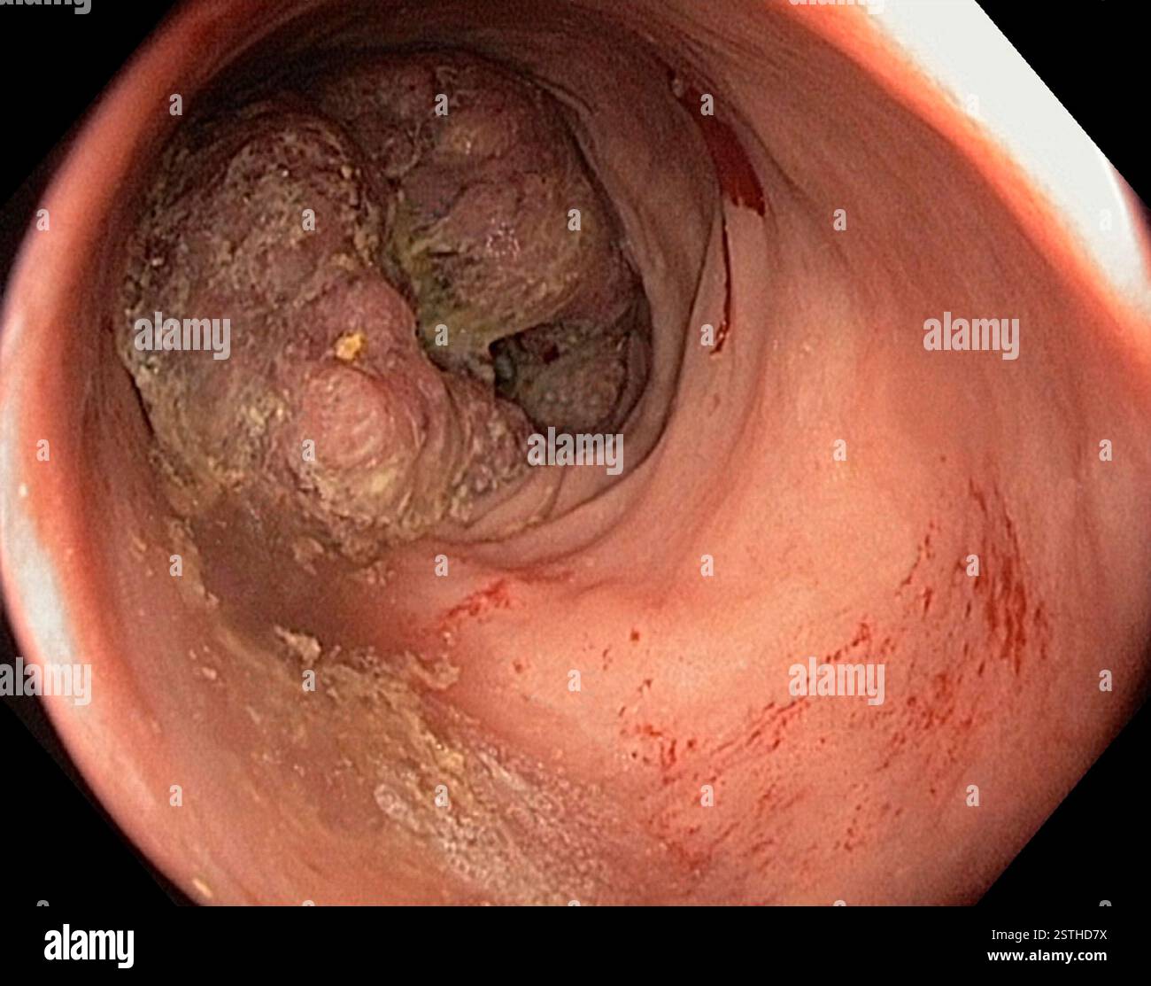 Colon cancer. Endoscopic view of a malignant (cancerous) adenocarcinoma ...