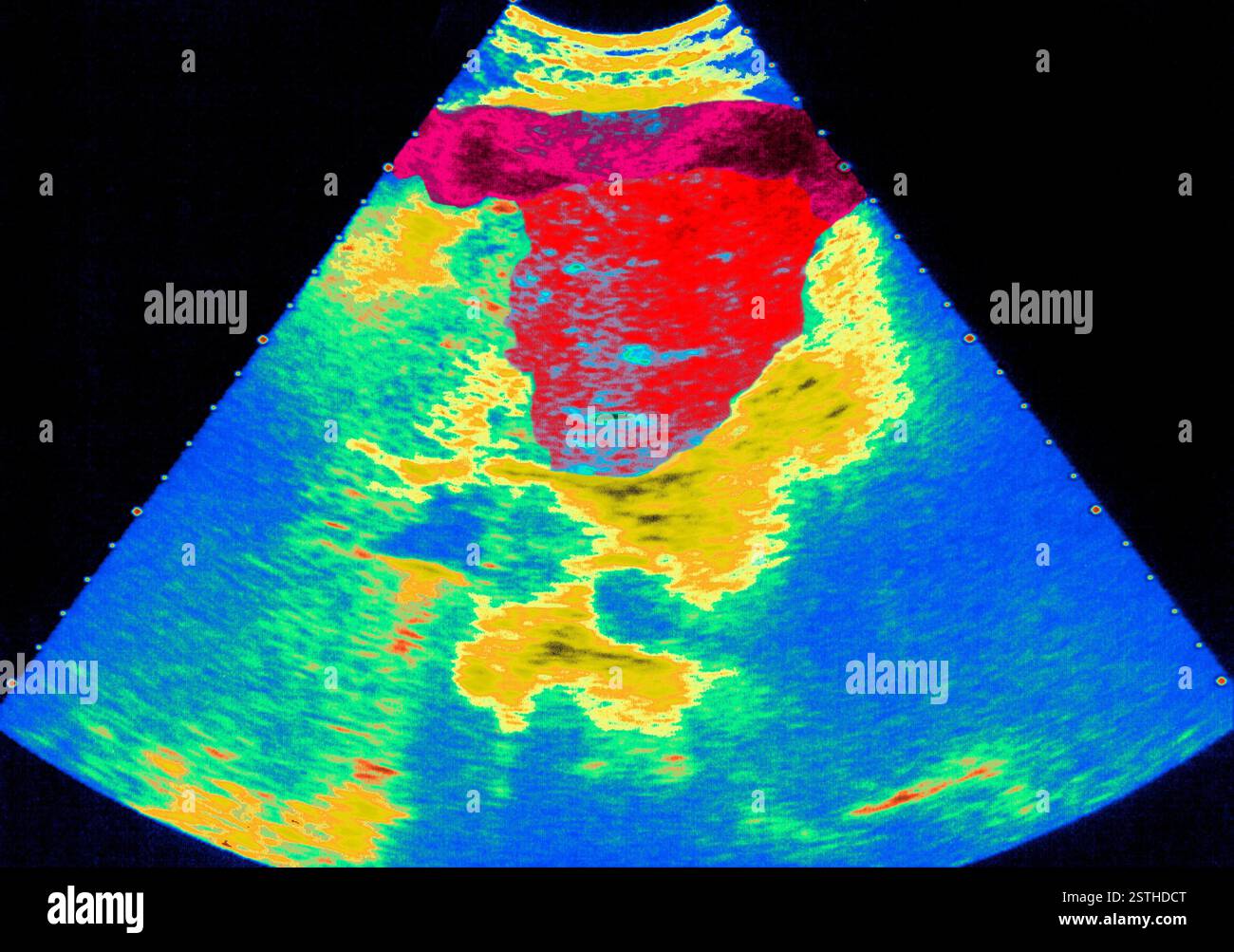Coloured ultrasound scan of the liver and biliary tract in the abdomen ...