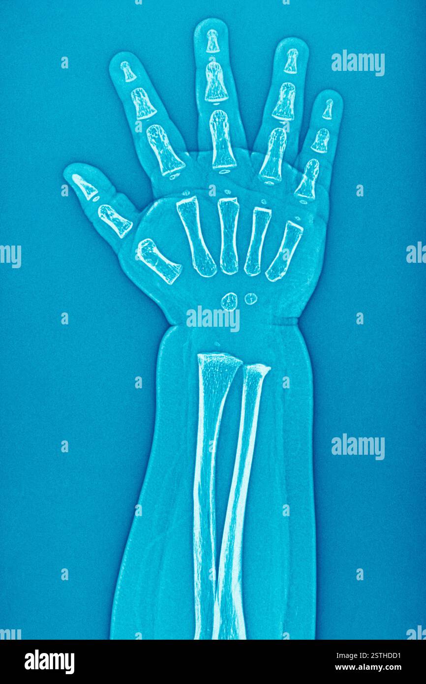 Normal baby's hand. Coloured X-ray of the healthy right hand and ...