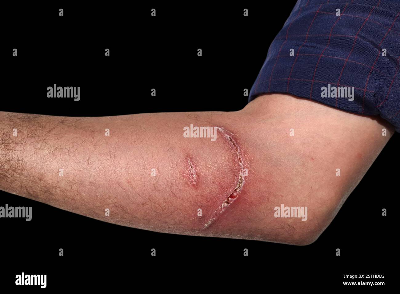 Jellyfish stings on the forearm of a 44 year old male patient. Some ...