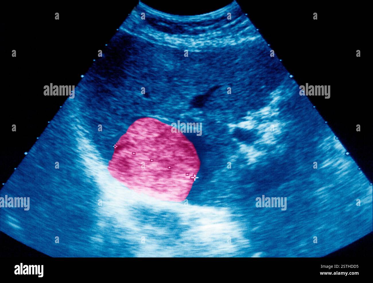 Coloured ultrasound scan of the liver in the abdomen in a patient ...