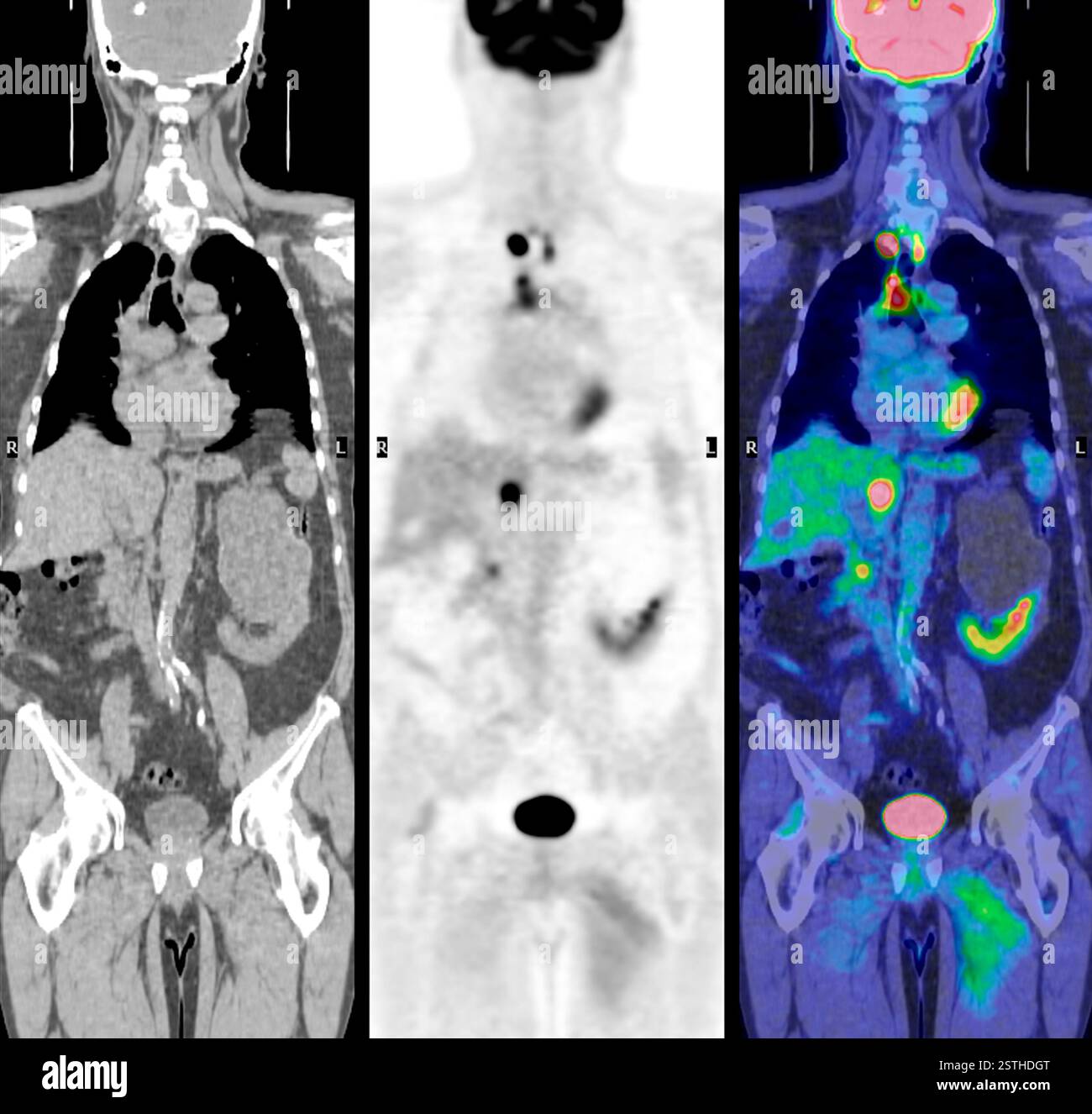 Secondary cancer. Computed tomography (CT, left) and positron emission tomography (PET, centre ...