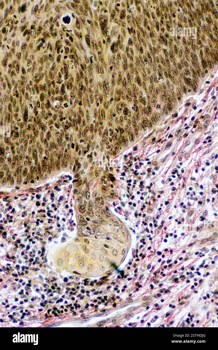 Uterine cancer. Light micrograph of a section through tissue from the ...