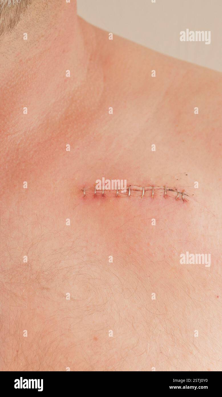 Heart pacemaker scar hi-res stock photography and images - Alamy