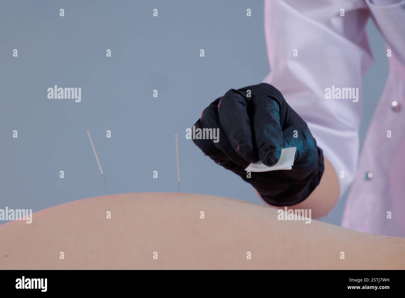 Close-up of a dry needling session where a practitioner inserts thin ...